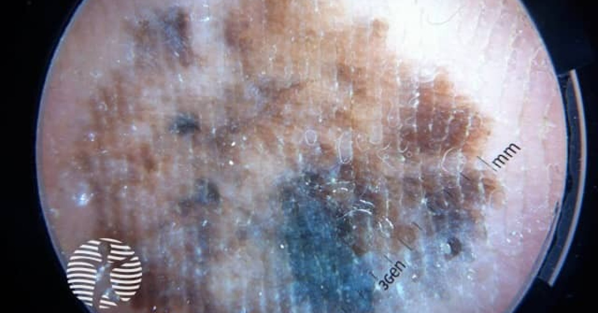Acral lentiginous melanoma dermoscopy image