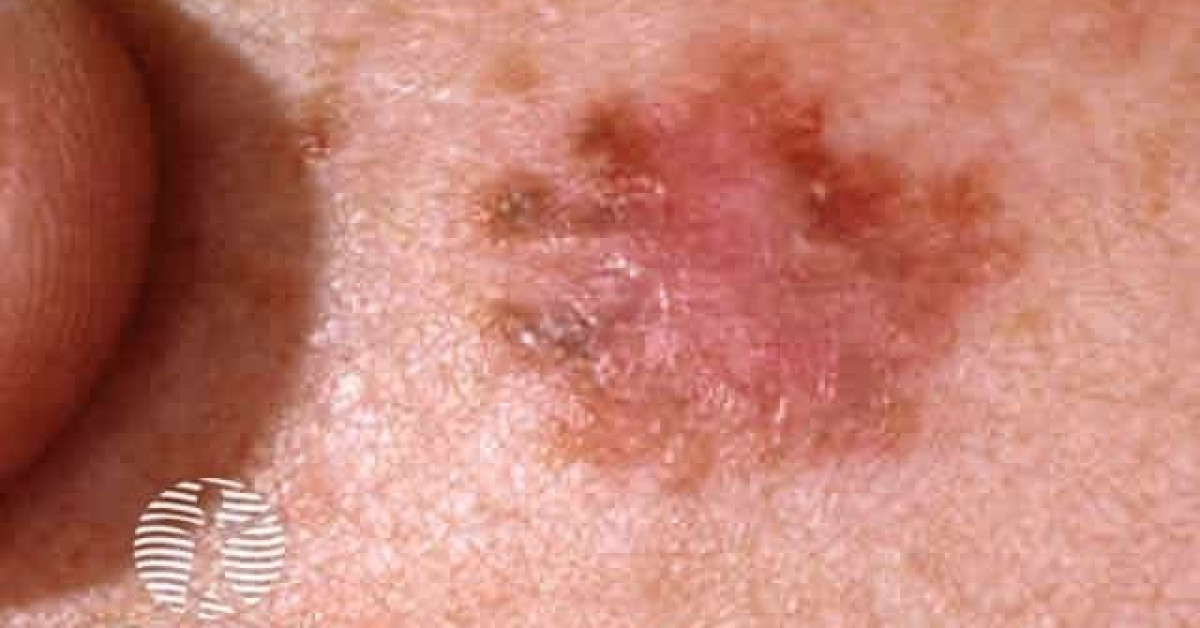Melanoma in situ image