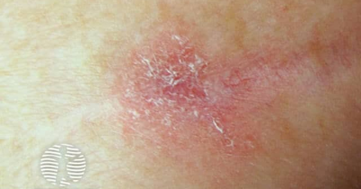 Amelanotic melanoma image
