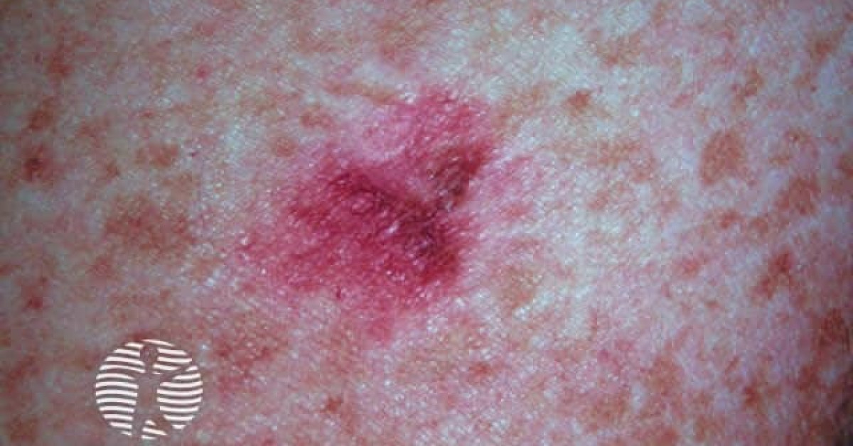 Amelanotic melanoma image