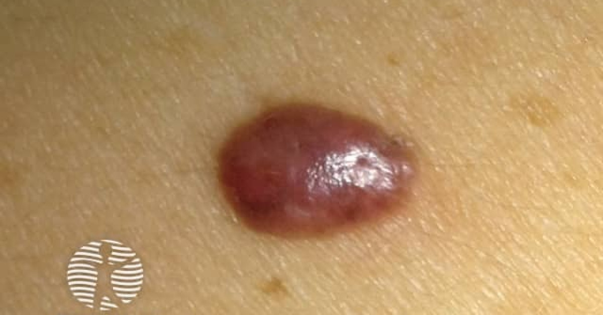 Amelanotic melanoma image