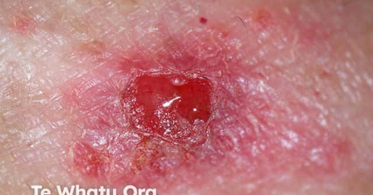 Amelanotic melanoma image