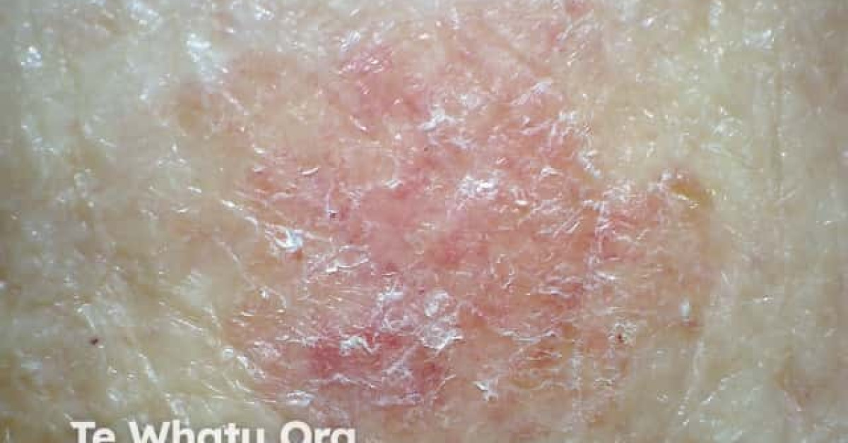 Amelanotic melanoma image
