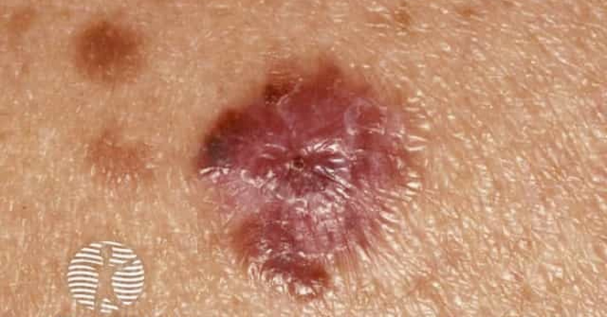 amelanotic melanoma 17 of 125 image