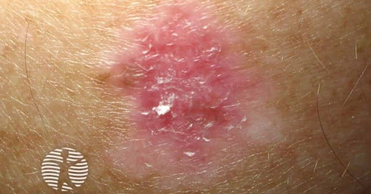 Amelanotic superficial spreading melanoma in situ image