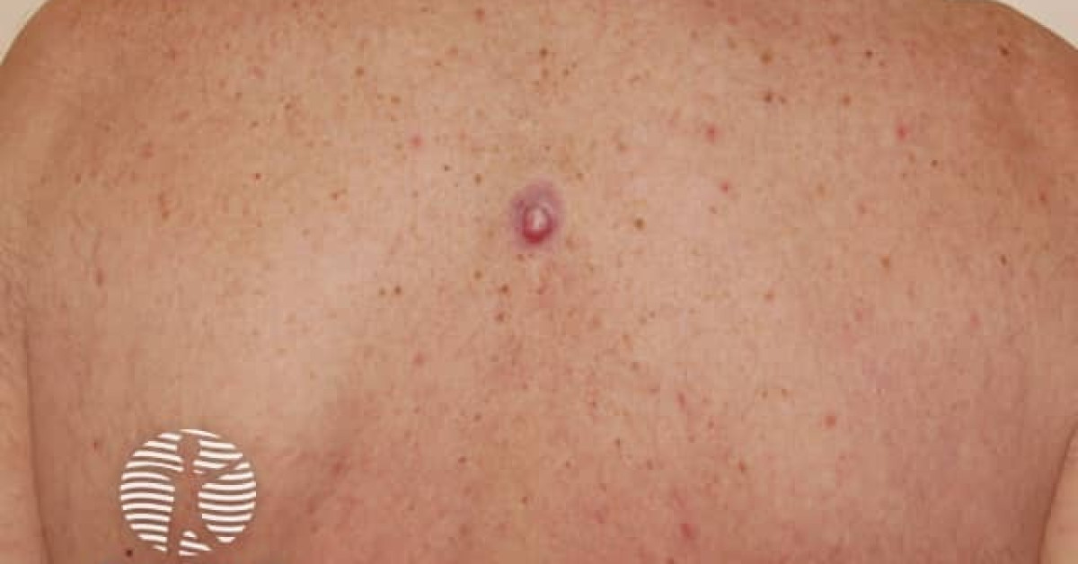 Amelanotic melanoma on the back image