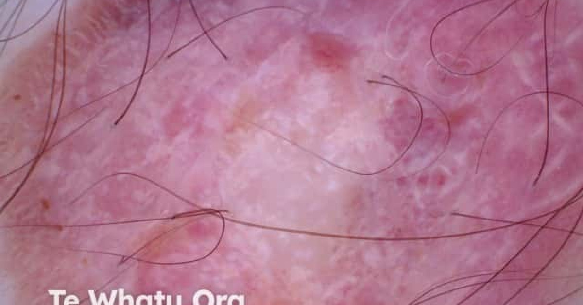 Amelanotic melanoma dermoscopy image