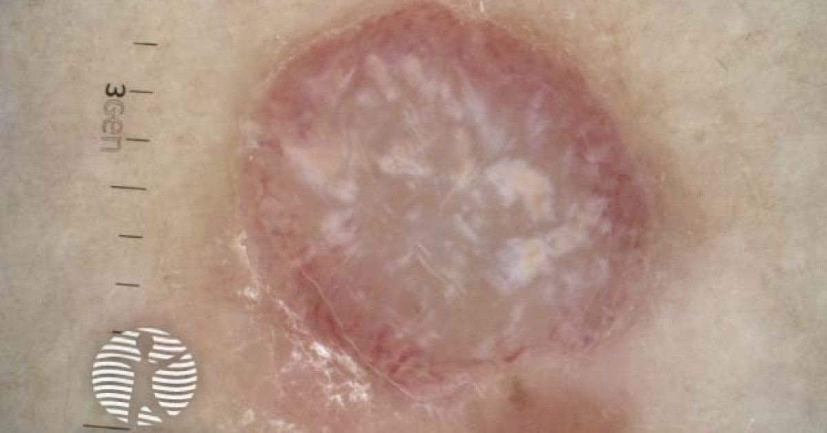 Amelanotic melanoma dermoscopy image