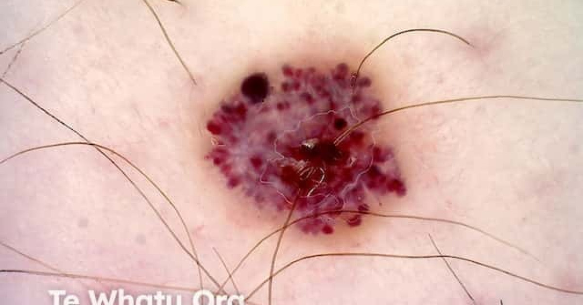 Angiokeratoma, polarised dermoscopy view image