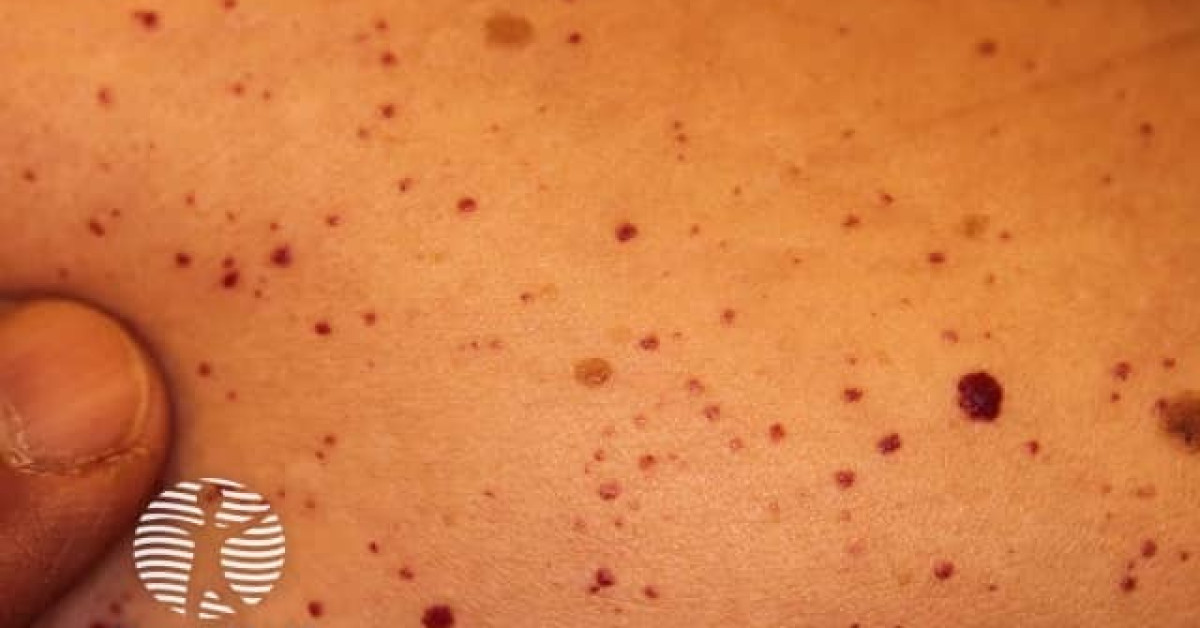 Angiokeratomas in suspected Fabry disease image