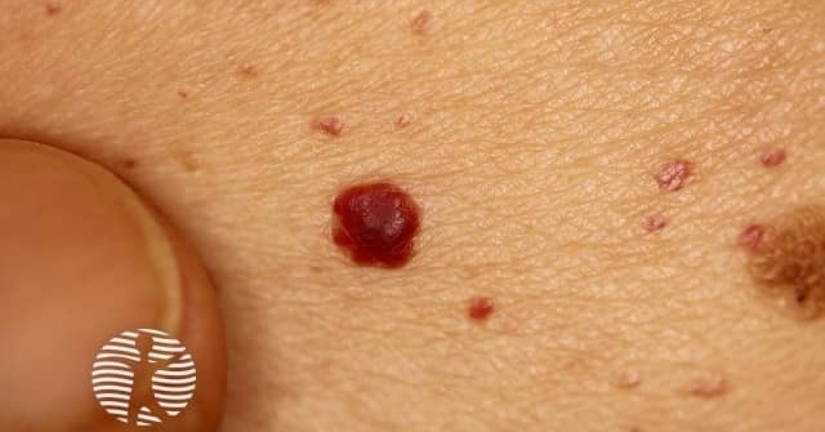 Angiokeratomas in suspected Fabry disease image