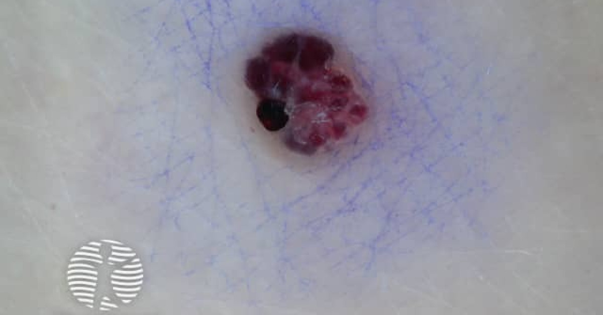 Dermoscopy of angiokeratoma of Fordyce on vulva image