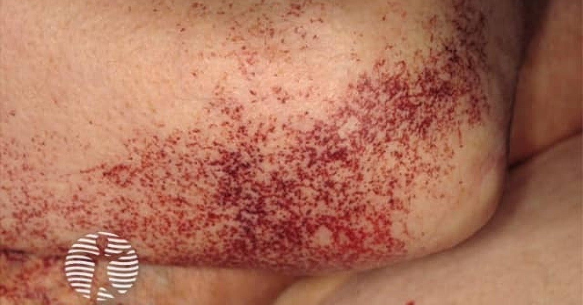 Angiokeratoma of Mibelli image