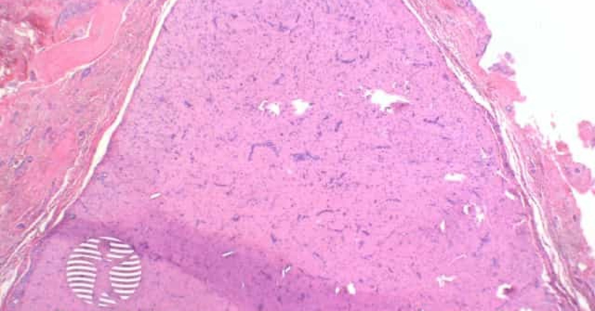 Angioleiomyoma histology image