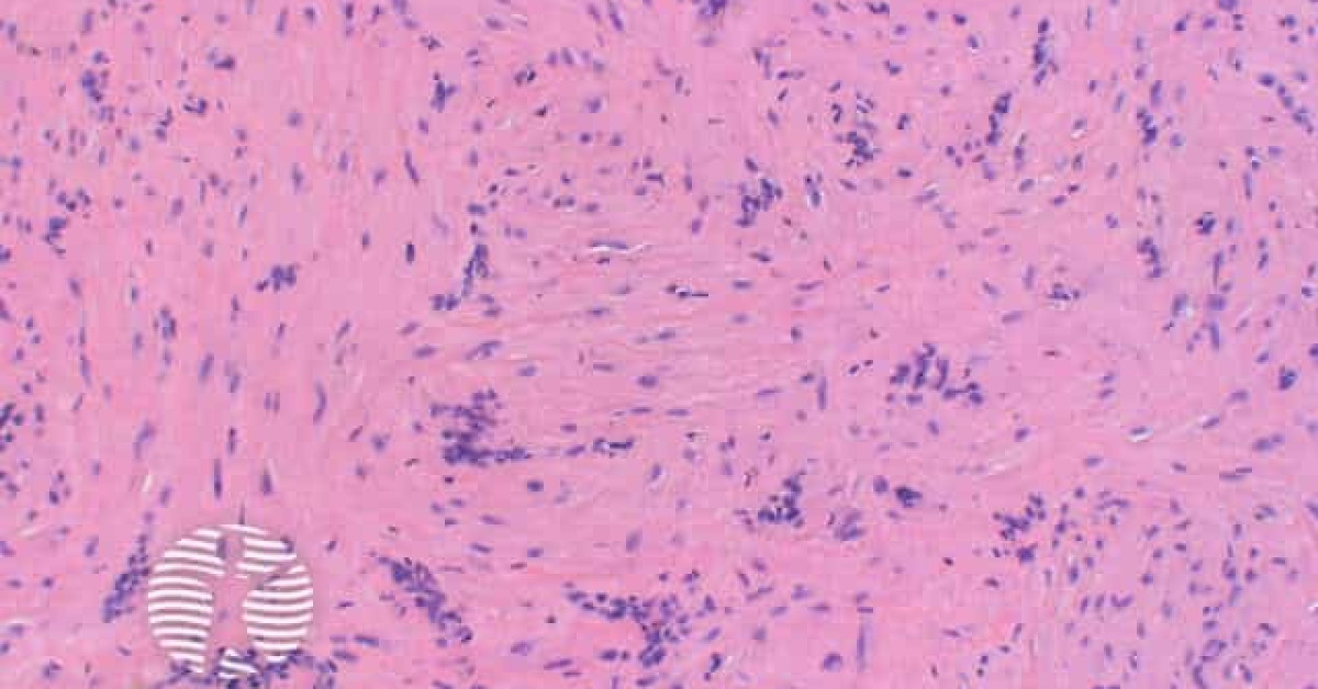 Angioleiomyoma histology image