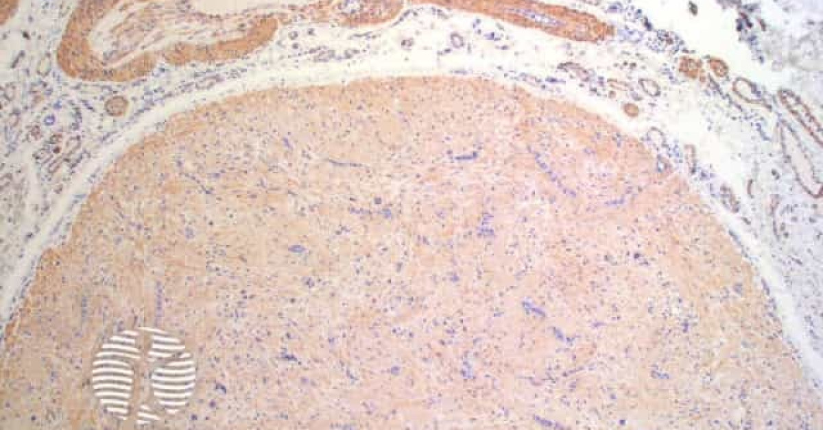 Angioleiomyoma SMA stain image