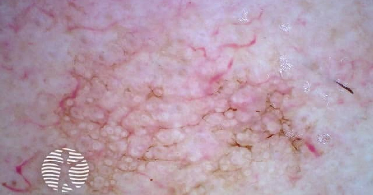 Pigmented actinic keratosis image