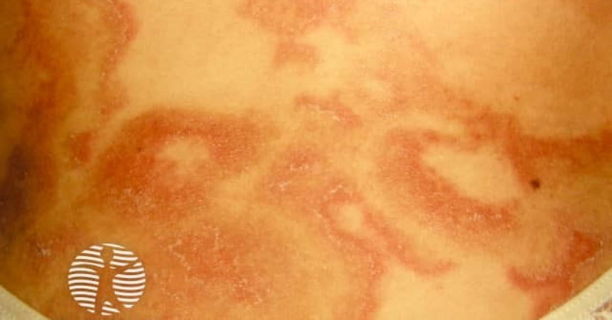 Annular erythema image