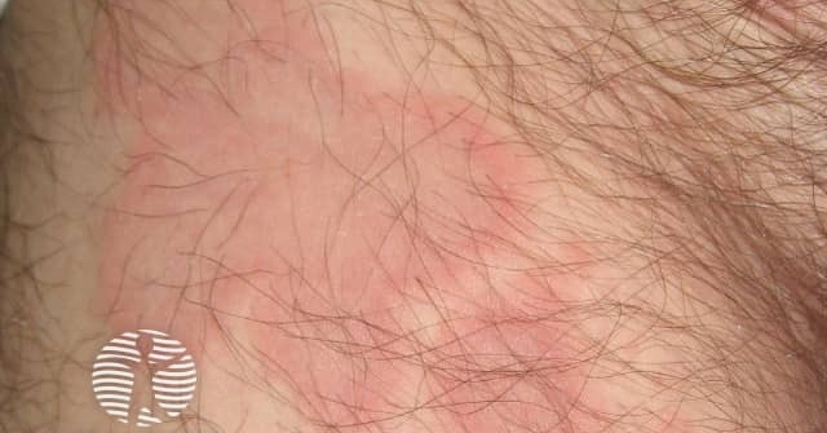 Erythema annulare centrifugum image