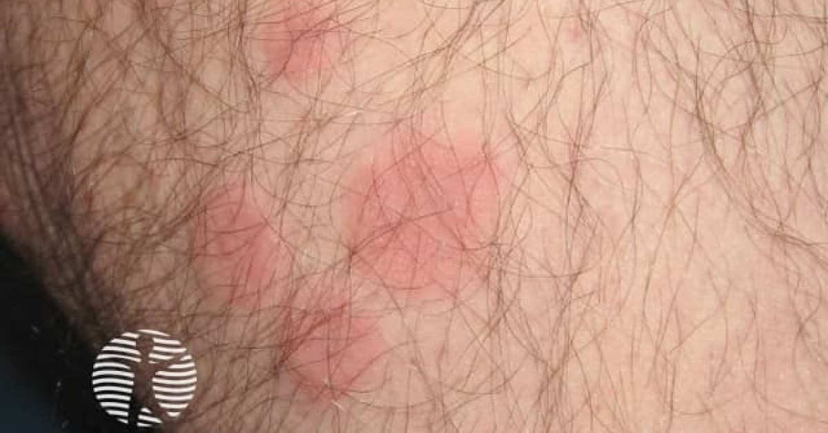 Annular erythema image