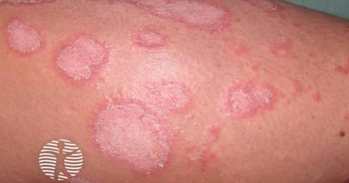 Erythema annulare centrifugum image