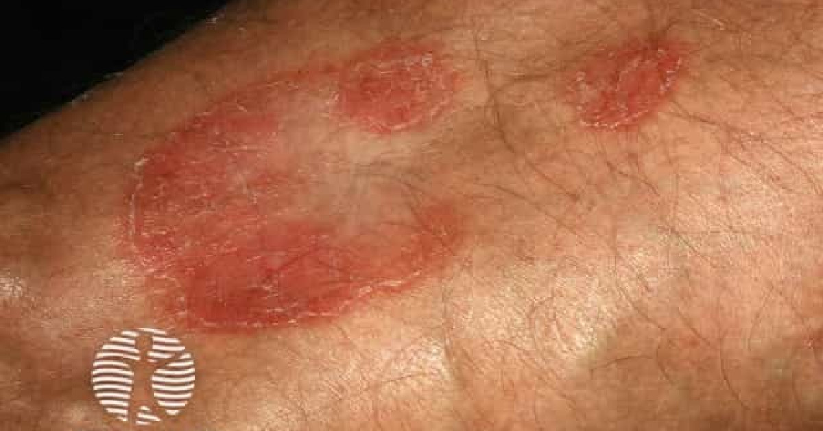 Erythema annulare centrifugum image