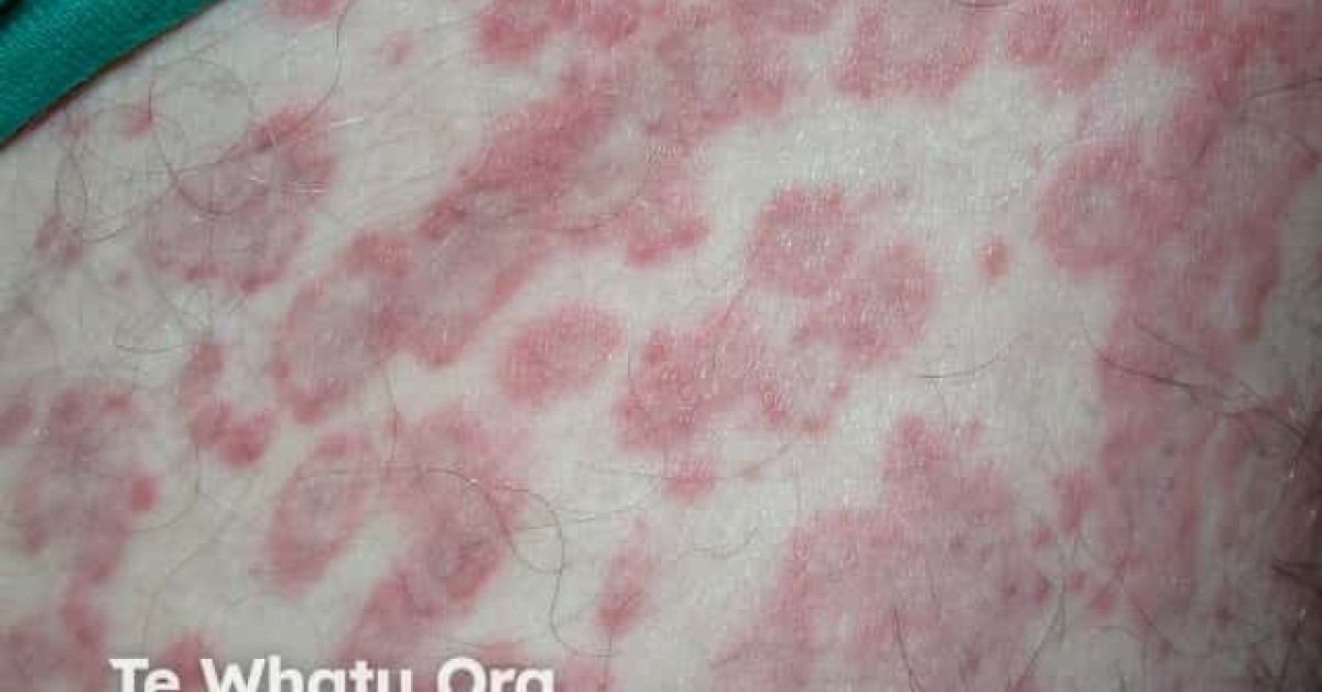 Erythema annulare centrifugum image