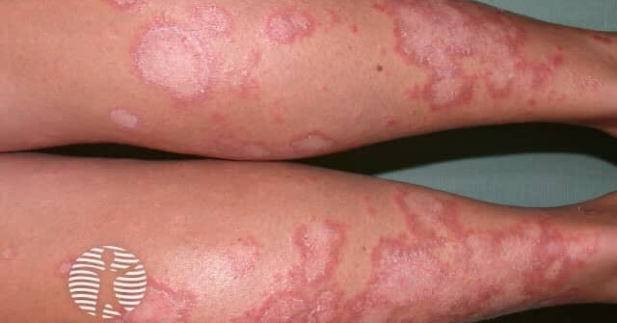 Erythema annulare centrifugum image