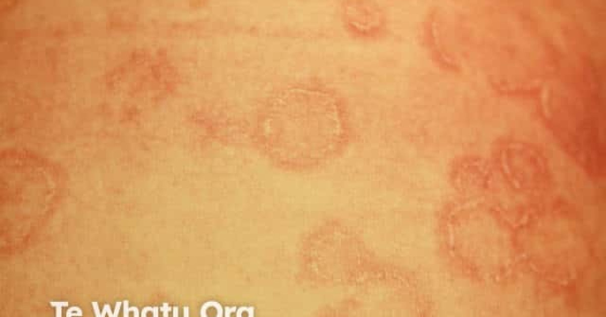 Erythema annulare centrifugum image