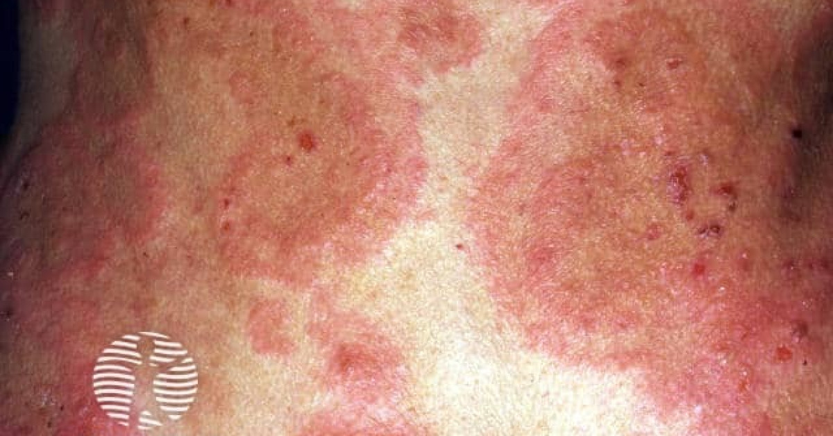 Erythema annulare centrifugum image