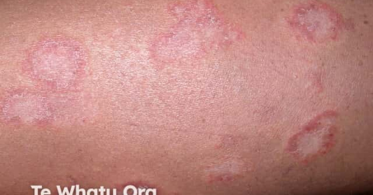 Erythema annulare centrifugum image