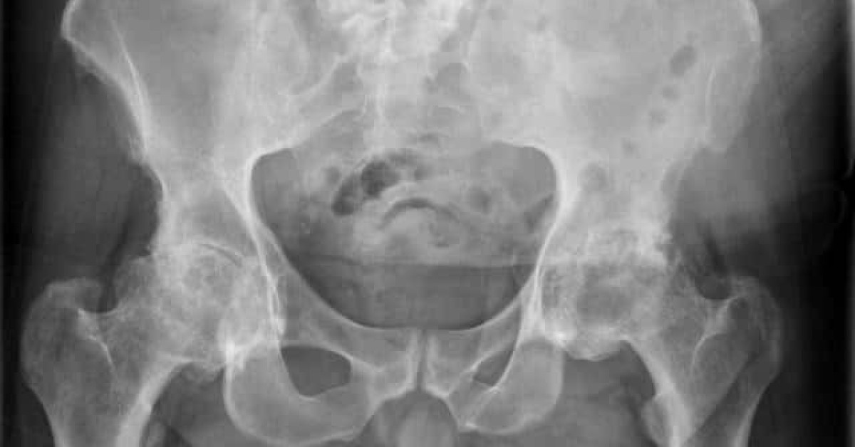 X-ray of AP view of pelvis with psoriatic arthritis image