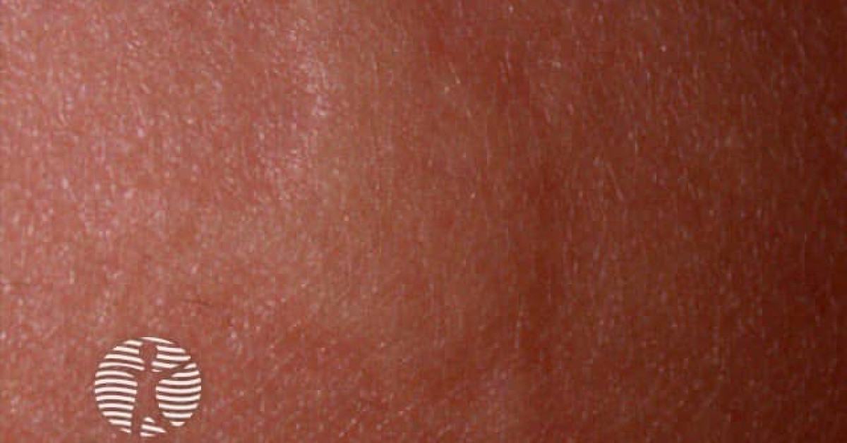 Insect bites image