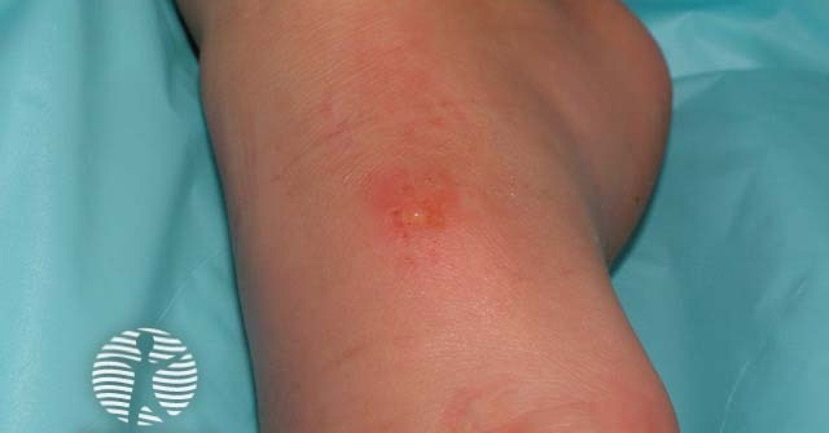 Insect bite image