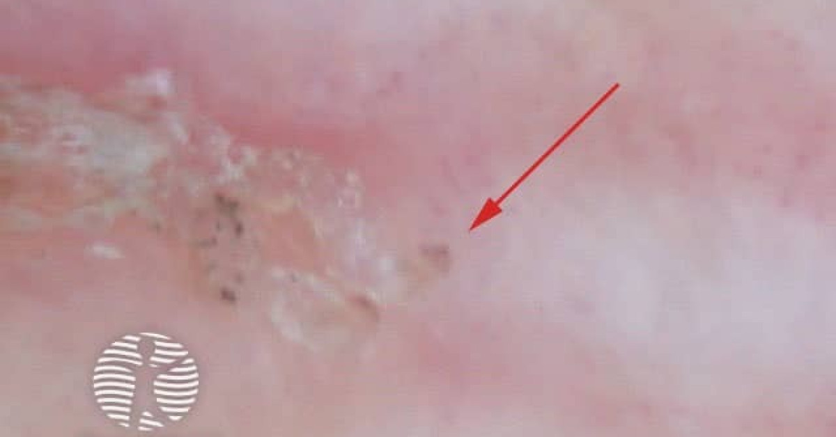 Scabies dermoscopy image