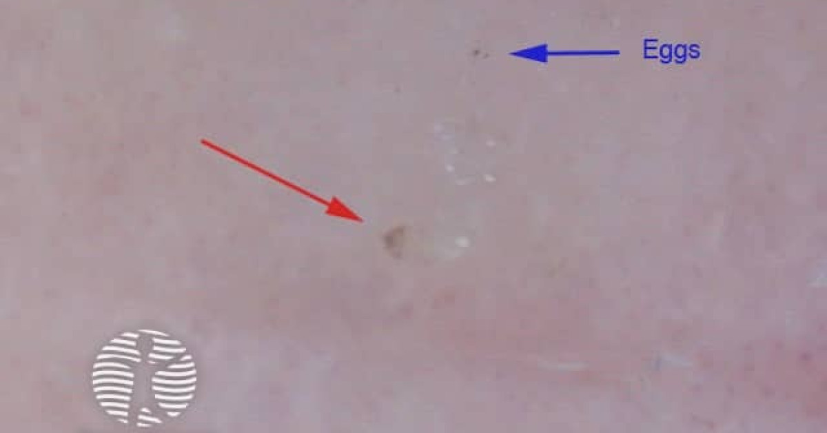 Scabies dermoscopy image