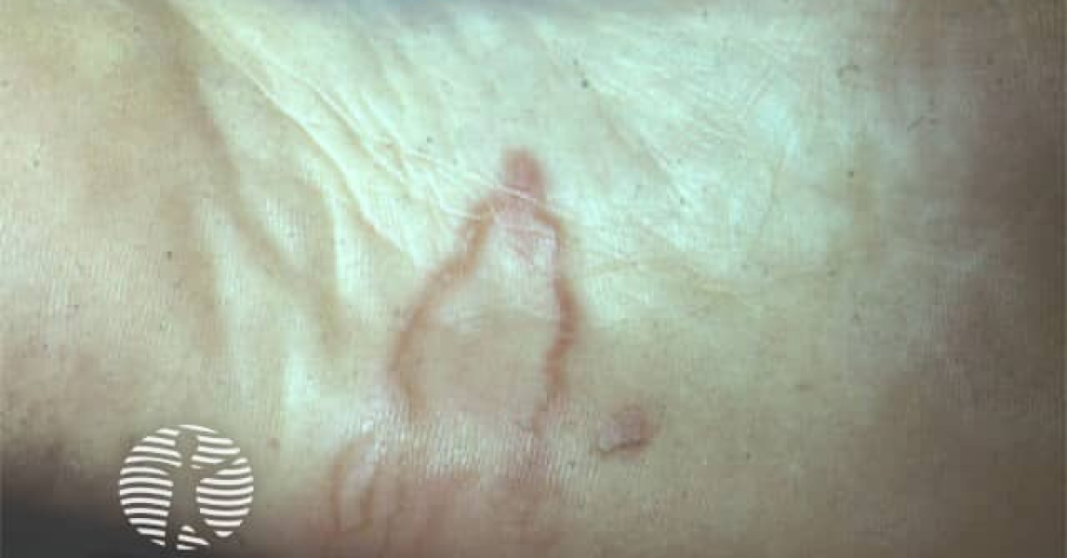 Cutaneous larva migrans image