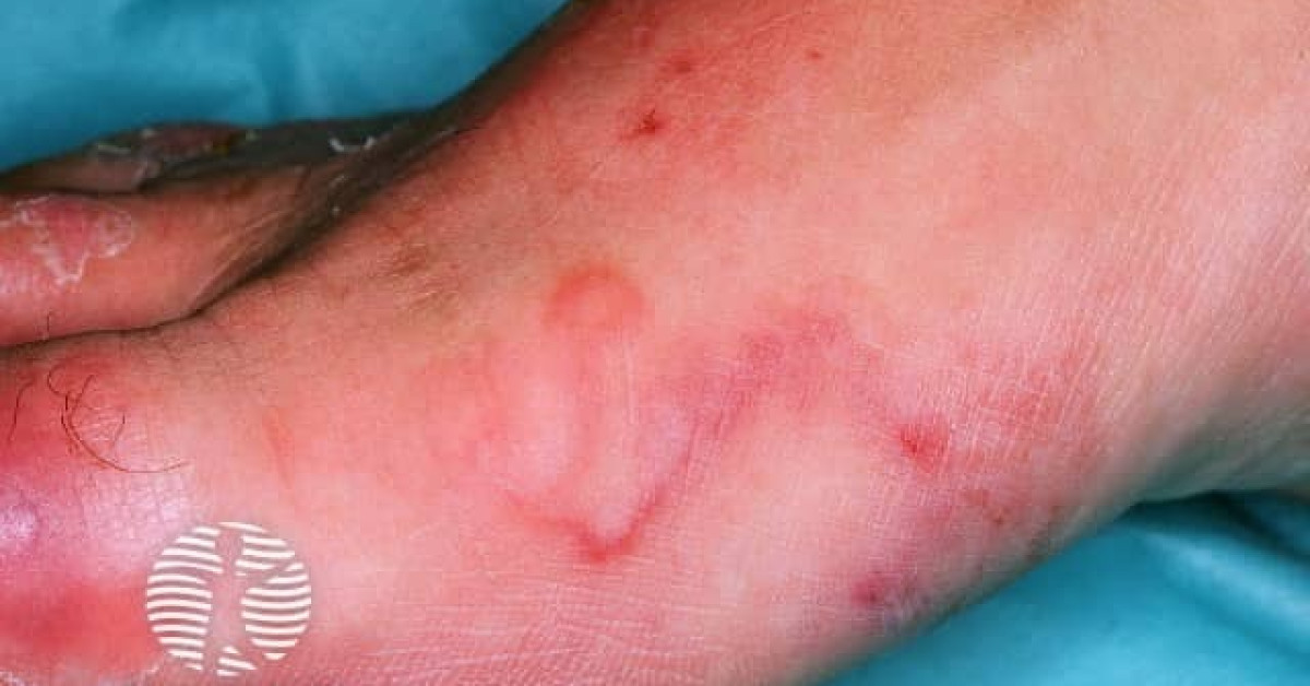 Cutaneous larva migrans image