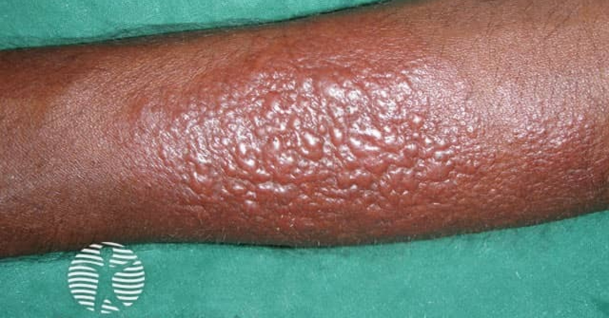 Leishmaniasis image