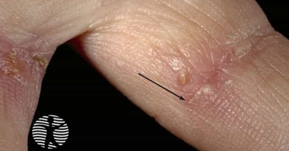 Scabies image