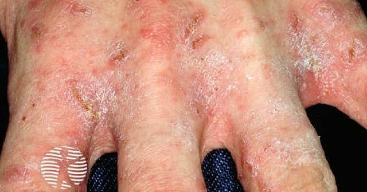 Scabies image