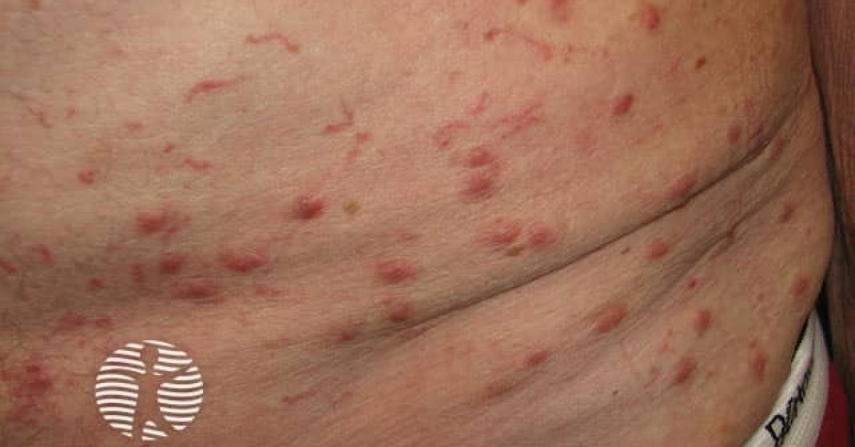 Scabies image