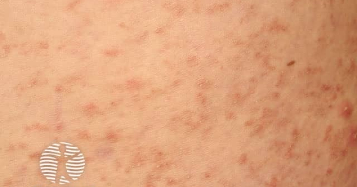 Dermnet Scabies Scabies