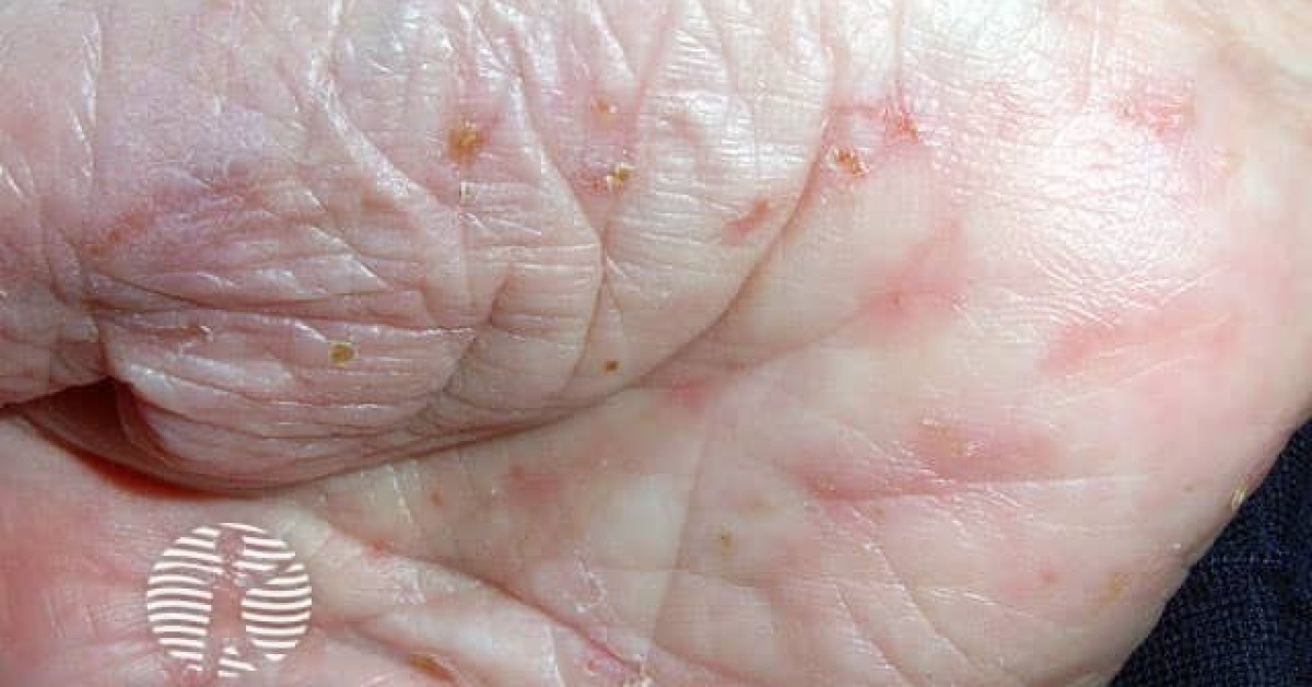 DermNet® - Scabies image