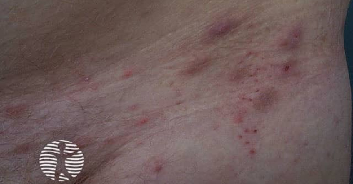 Scabies image