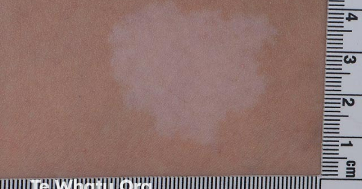 Ash leaf macule in tuberous sclerosis image