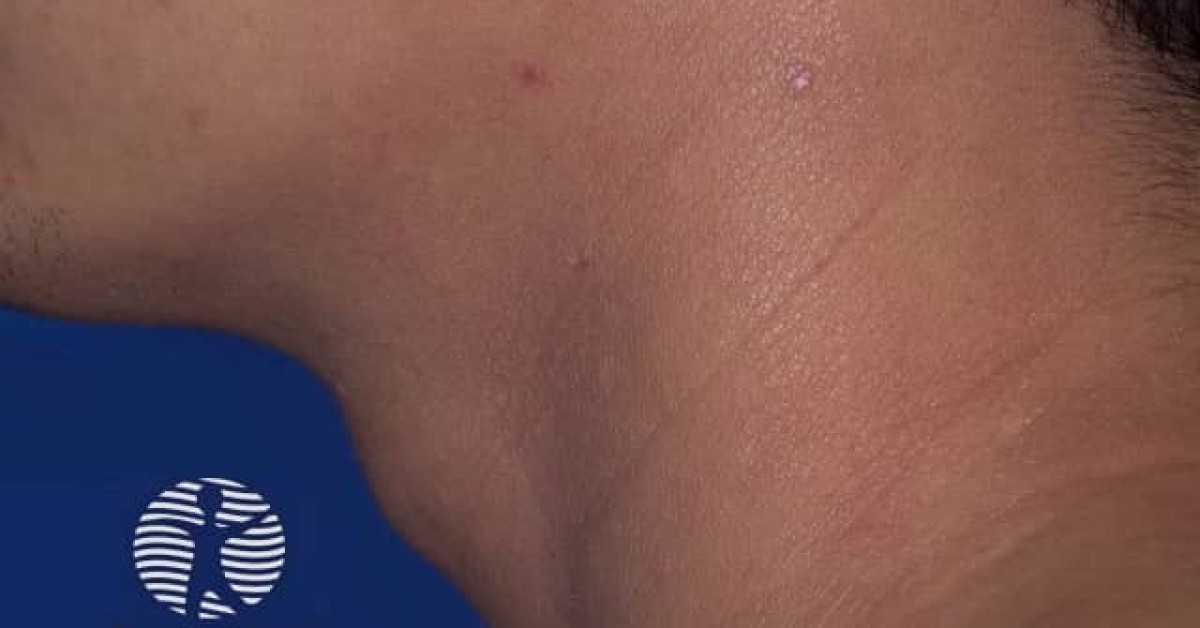 Atopic dermatitis of neck image