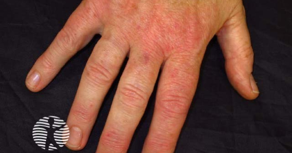 Atopic hand dermatitis image