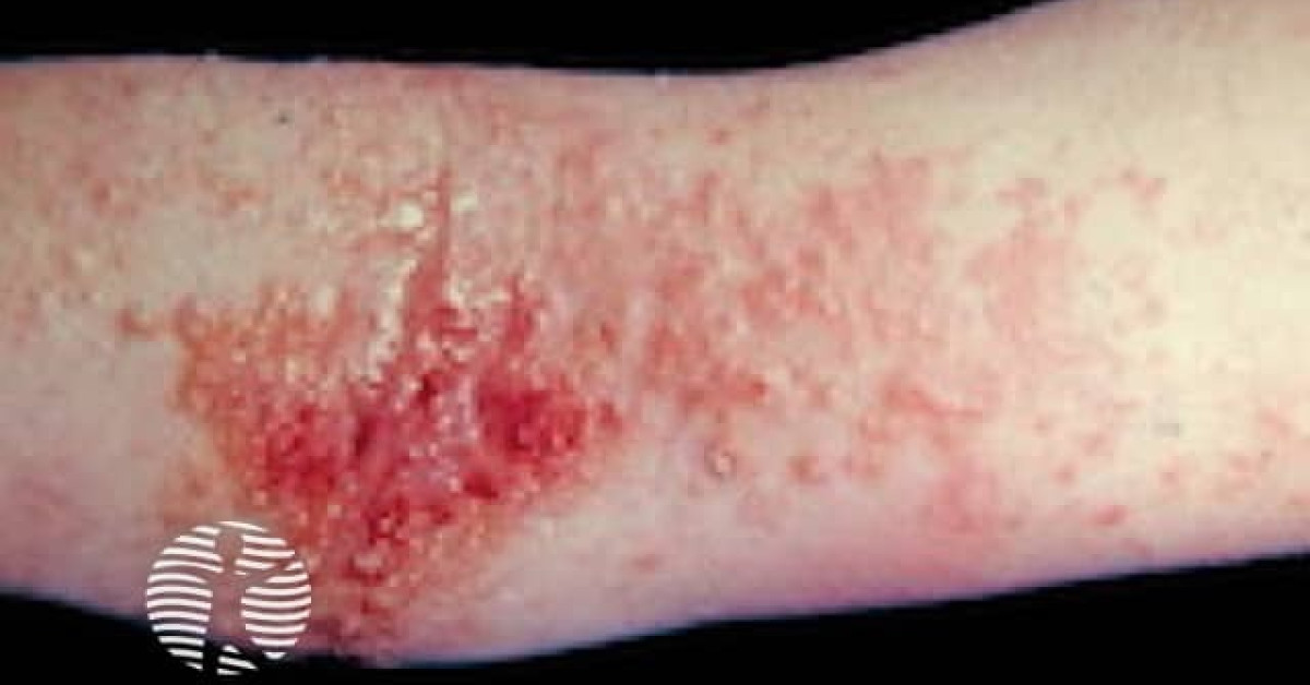 Atopic eczema image