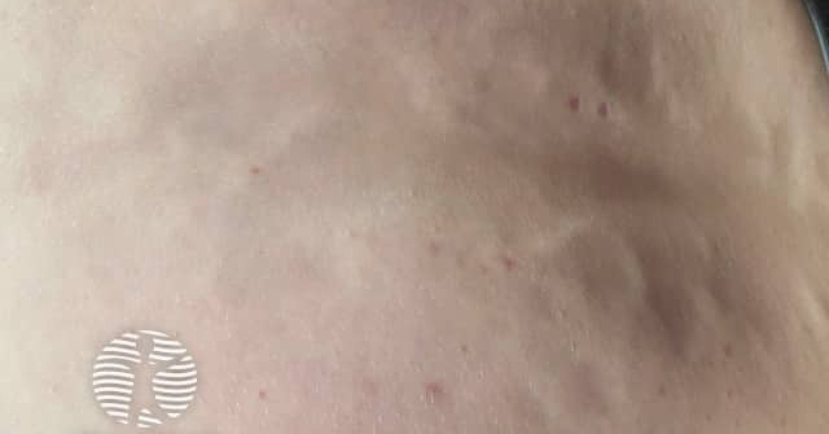 Atrophoderma of Pierini and Pasini image